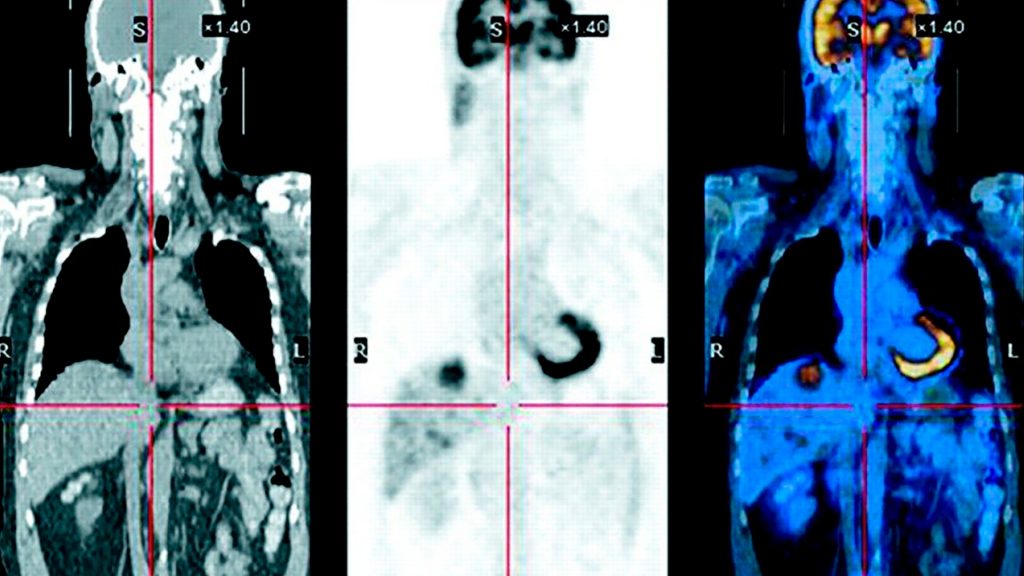 Exame PET/CT: você sabe o que é? – Spect